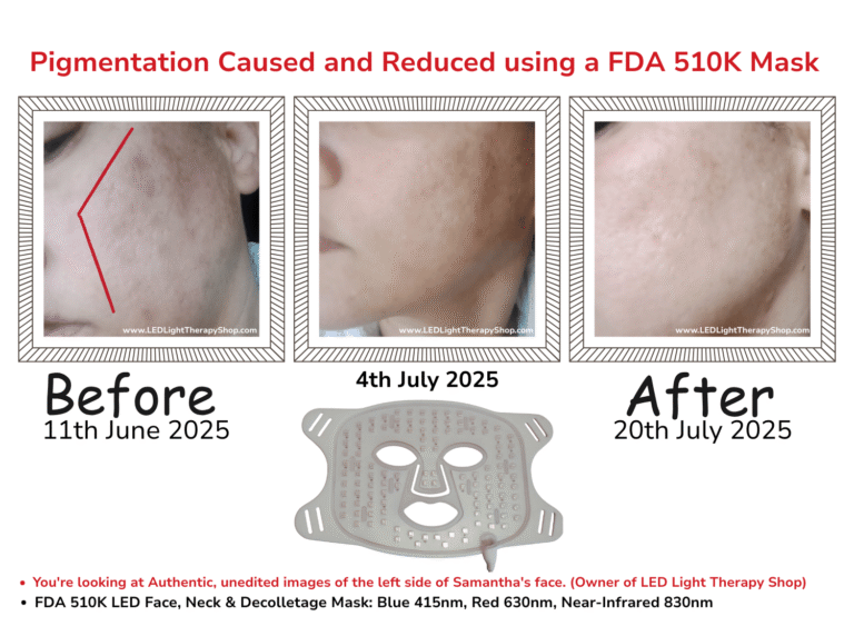 My Mixed-Race Skin, Pigmentation & LED Mask: The "Gold Standard" Is ...